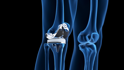 Knee Implants | Devices | Croom Medical