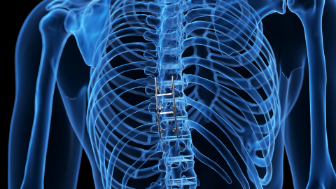 Spine Implants | Devices | Croom Medical